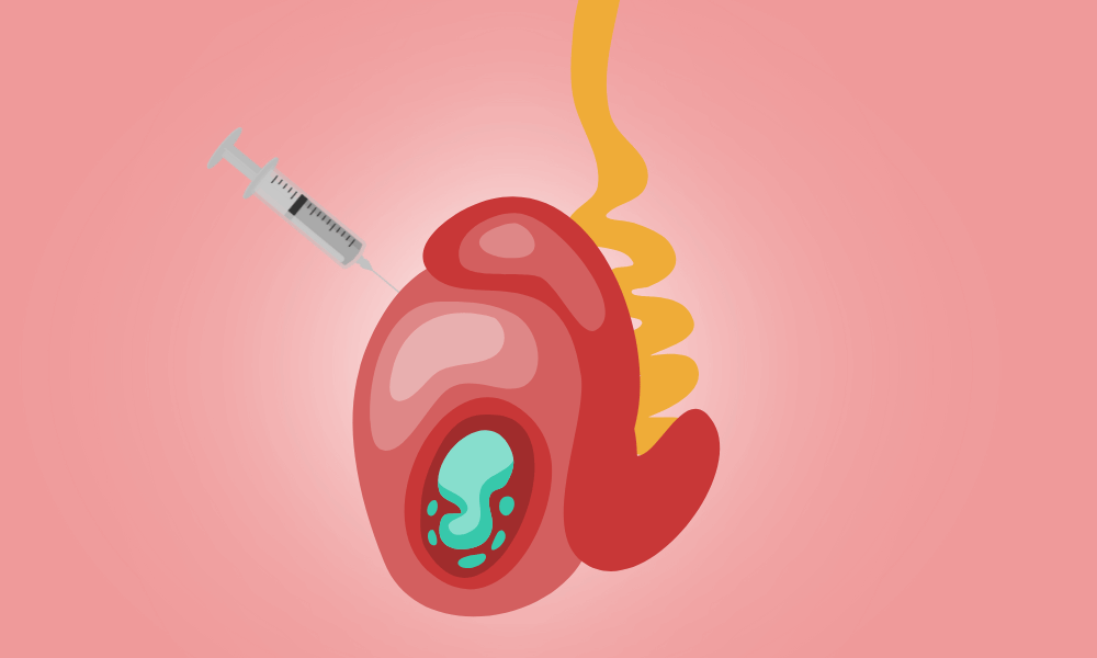 PESA and TESA in Bangalore | Mamatha Fertility & IVF